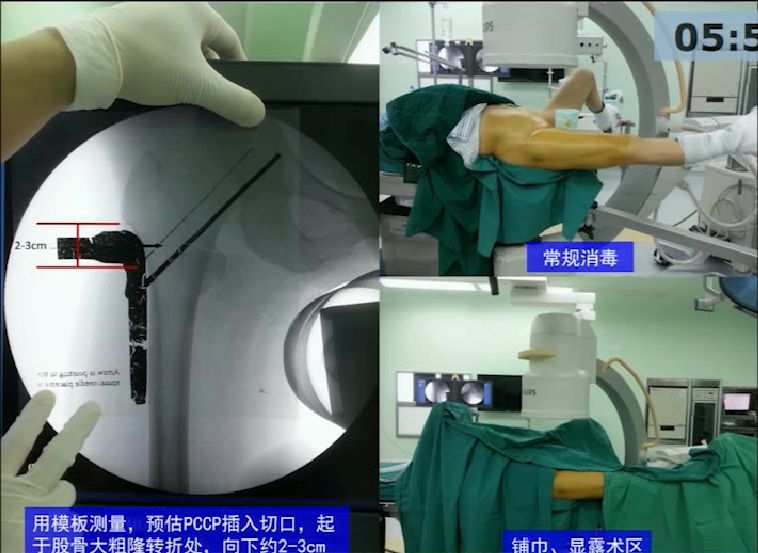经皮加压钢板PCCP 治疗股骨颈骨折 上海开为医药科技有限公司 创伤肢体矫形技术解决方案的专业服务商