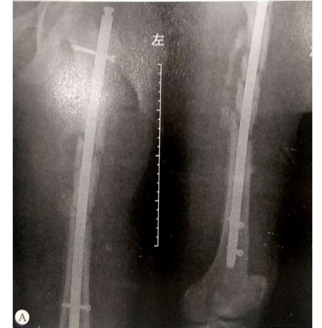 8分钟创伤骨不连治疗很棘手看完这篇轻松掌握 上海开为医药科技有限公司 创伤肢体矫形技术解决方案的专业服务商