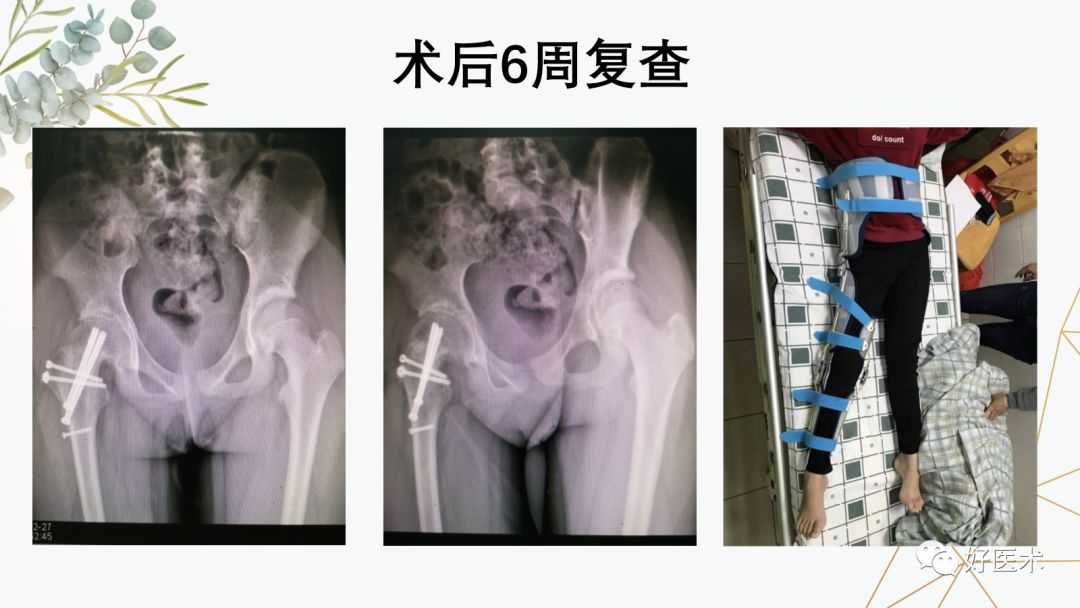 早读 关于股骨头骨骺滑脱的诊治策略这篇课件我打满分 上海开为医药科技有限公司 创伤肢体矫形技术解决方案的专业服务商