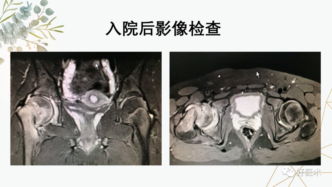 早读 关于股骨头骨骺滑脱的诊治策略这篇课件我打满分 上海开为医药科技有限公司 创伤肢体矫形技术解决方案的专业服务商