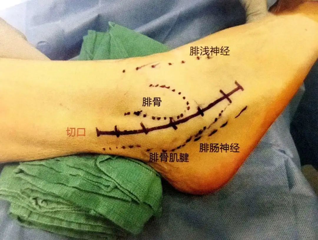 『8分钟运医』 一文读懂：改良 Brostrom手术要点及操作技巧 - 上海开为医药科技有限公司--创伤、肢体矫形技术解决方案的专业服务商