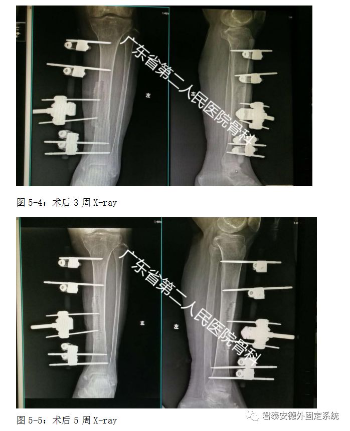 横向骨搬运原理应用案例及术后护理 上海开为医药科技有限公司 创伤肢体矫形技术解决方案的专业服务商