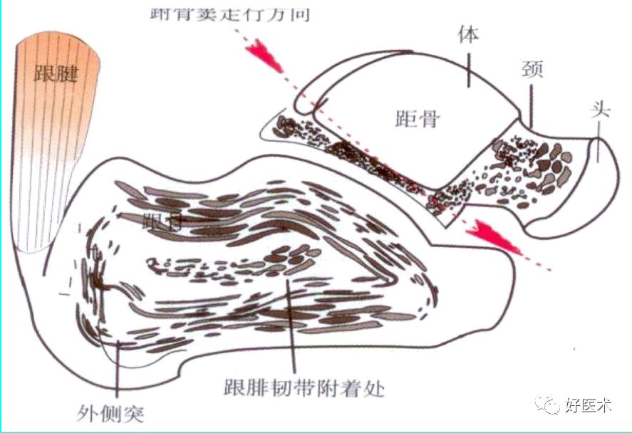 早读 一篇文章全面了解跗骨窦综合征 上海开为医药科技有限公司 创伤肢体矫形技术解决方案的专业服务商