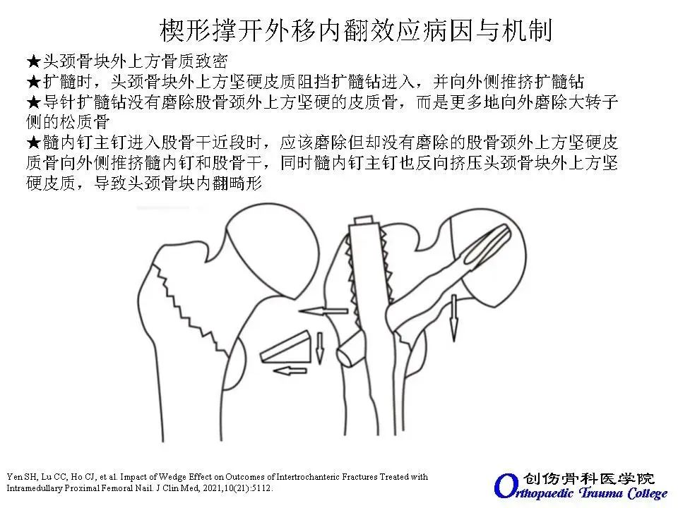 股骨转子间骨折髓内钉固定中的楔形撑开外移内翻效应 上海开为医药科技有限公司 创伤肢体矫形技术解决方案的专业服务商