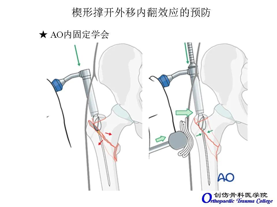 股骨转子间骨折髓内钉固定中的楔形撑开外移内翻效应 上海开为医药科技有限公司 创伤肢体矫形技术解决方案的专业服务商