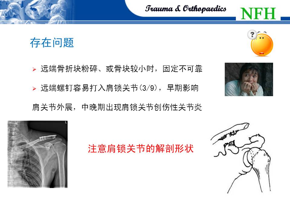解剖型锁定钢板治疗锁骨远端骨折的临床研究 唯医 allinmd 上海开为医药科技有限公司 创伤肢体矫形技术解决方案的专业服务商