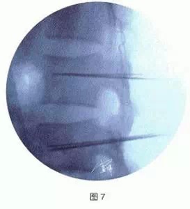 全方位解读腰椎椎弓根钉的固定技术 上海开为医药科技有限公司 创伤肢体矫形技术解决方案的专业服务商