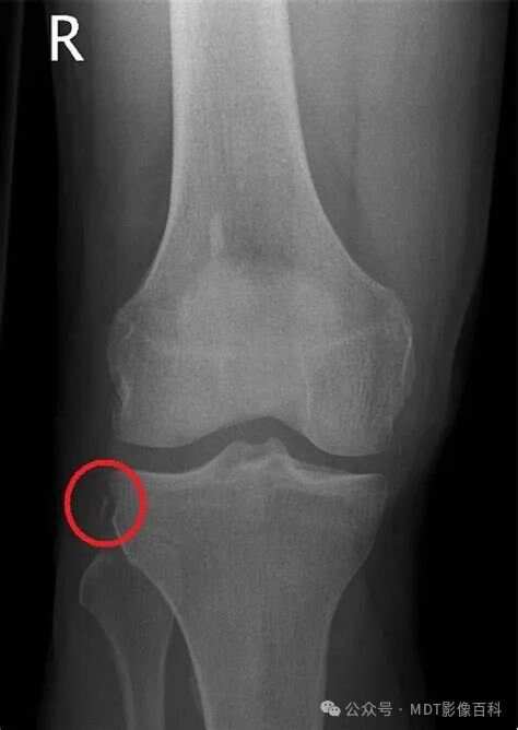 Segond骨折的发生机制及影像诊断 - 上海开为医药科技有限公司--创伤、肢体矫形技术解决方案的专业服务商