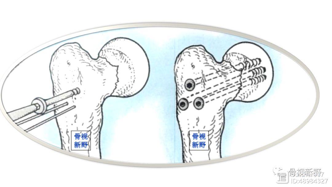 创伤︱股骨颈骨折内固定的稳定优化 - 上海开为医药科技有限公司--创伤、肢体矫形技术解决方案的专业服务商