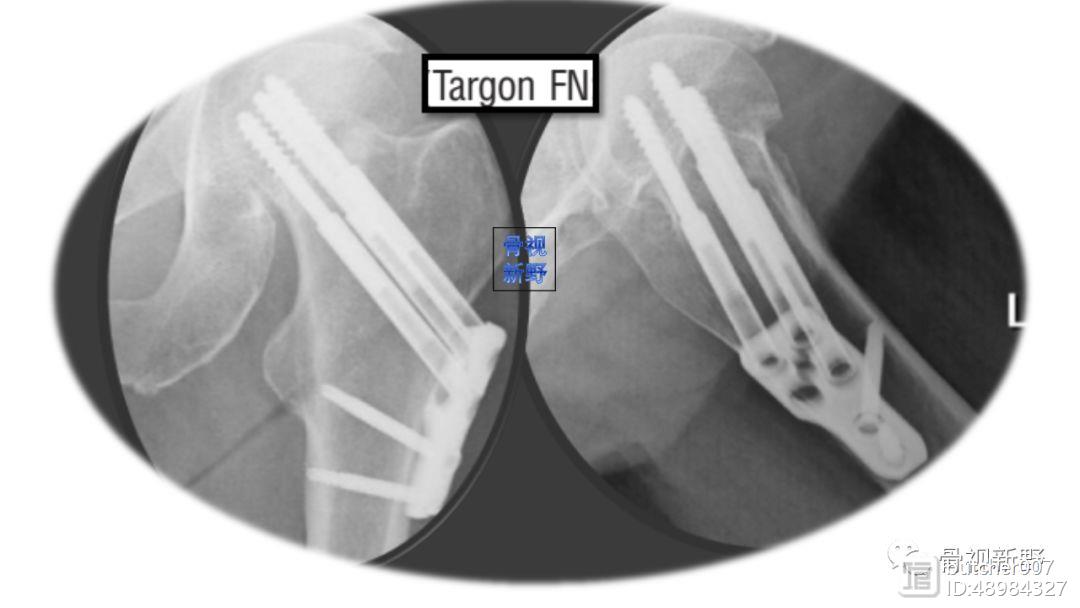 创伤︱股骨颈骨折内固定的稳定优化 - 上海开为医药科技有限公司--创伤、肢体矫形技术解决方案的专业服务商