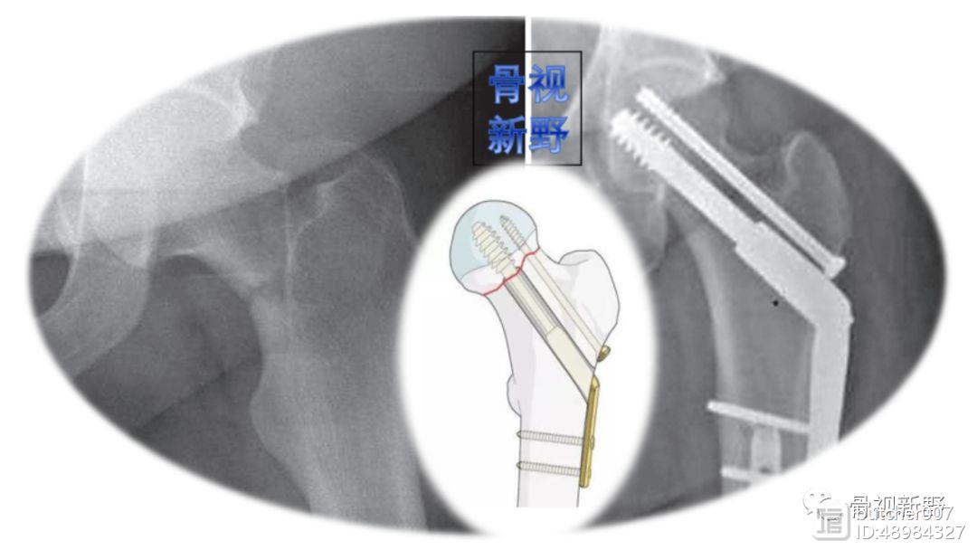 创伤︱股骨颈骨折内固定的稳定优化 - 上海开为医药科技有限公司--创伤、肢体矫形技术解决方案的专业服务商