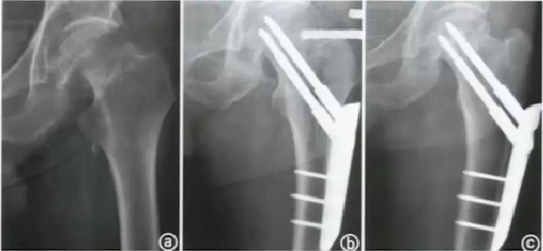 经皮加压钢板（PCCP)治疗股骨颈骨折 - 上海开为医药科技有限公司--创伤、肢体矫形技术解决方案的专业服务商