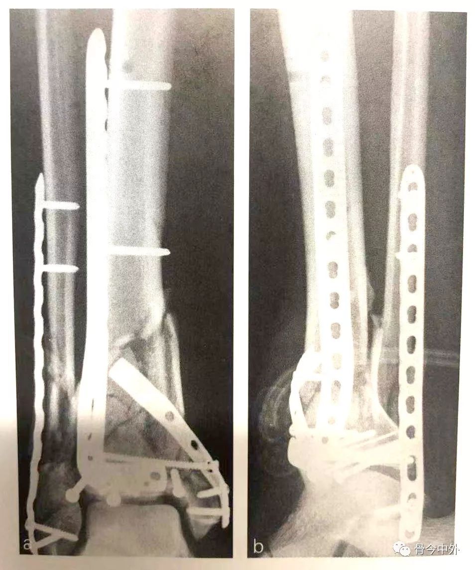 MIPO技术治疗复杂关节内Pilon骨折伴腓骨远端多段骨折 - 上海开为医药科技有限公司--创伤、肢体矫形技术解决方案的专业服务商