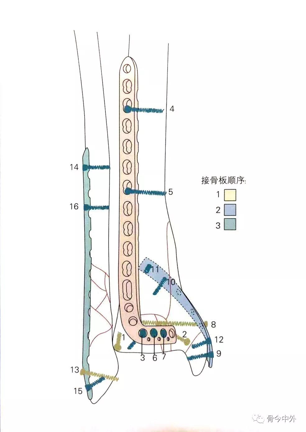 MIPO技术治疗复杂关节内Pilon骨折伴腓骨远端多段骨折 - 上海开为医药科技有限公司--创伤、肢体矫形技术解决方案的专业服务商