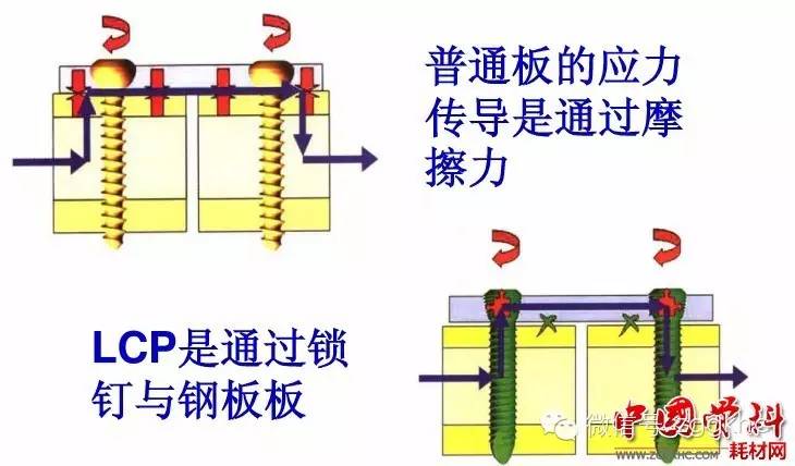 你知道什么是LCP钢板吗？ - 上海开为医药科技有限公司--创伤、肢体矫形技术解决方案的专业服务商