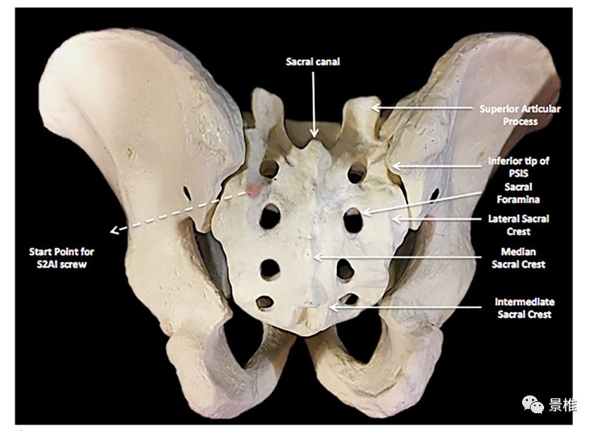 intermediate sacral crest中文
