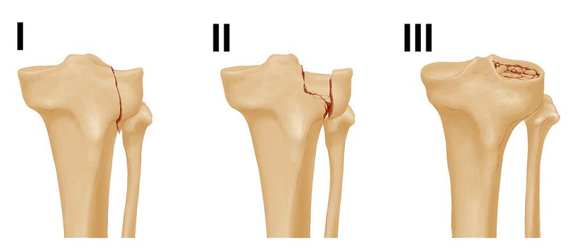 最新！Schatzker改良Schatzker分型 - 上海开为医药科技有限公司--创伤、肢体矫形技术解决方案的专业服务商