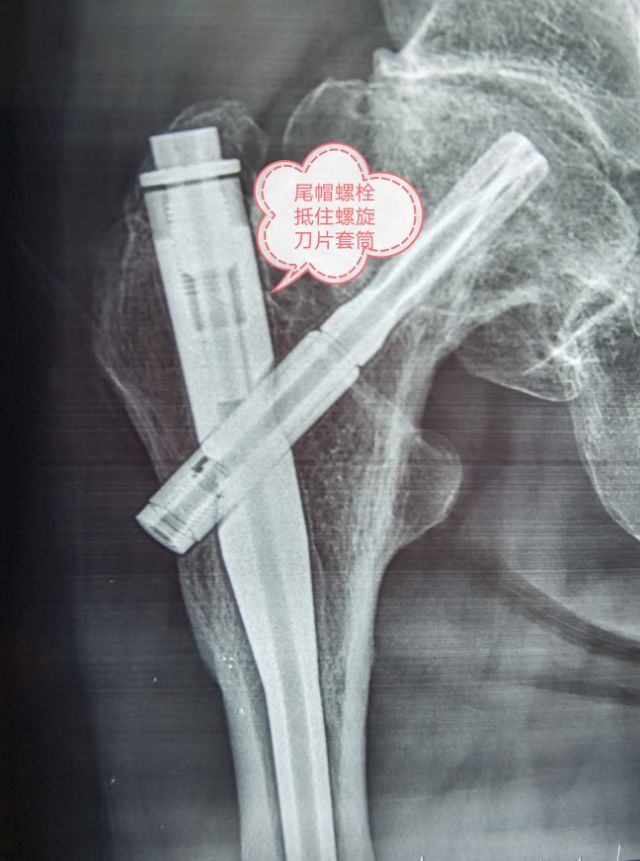 困难PFNA取出方法 - 上海开为医药科技有限公司--创伤、肢体矫形技术解决方案的专业服务商