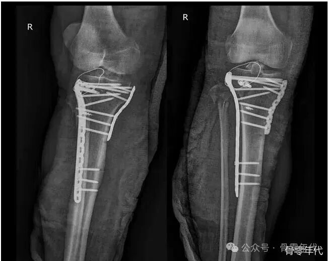 胫骨平台骨折伴髌腱断裂的骨折不愈合 - 上海开为医药科技有限公司--创伤、肢体矫形技术解决方案的专业服务商