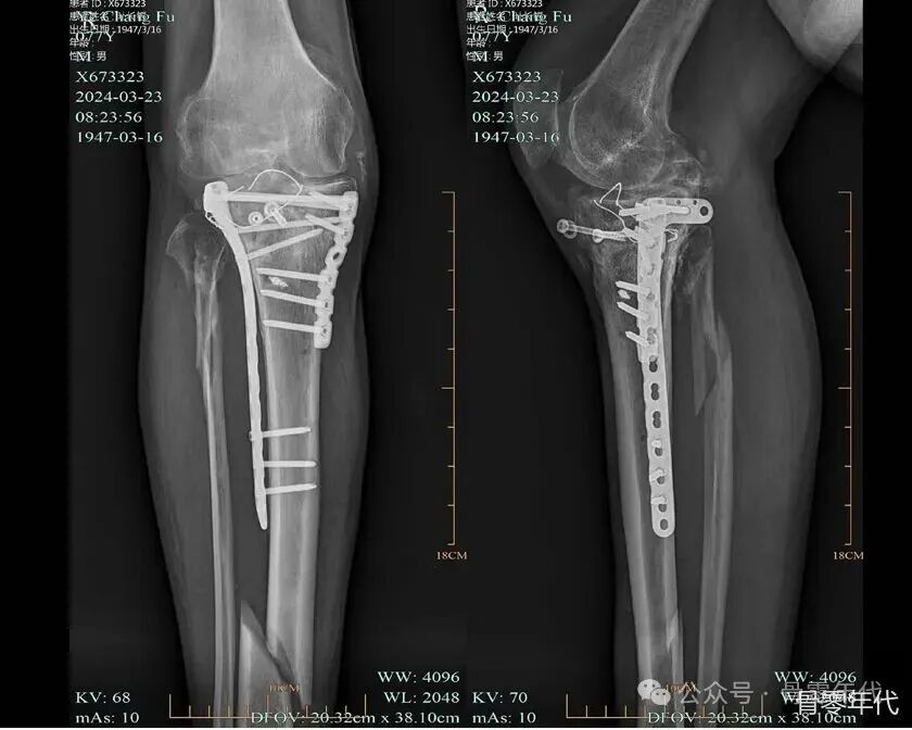 胫骨平台骨折伴髌腱断裂的骨折不愈合 - 上海开为医药科技有限公司--创伤、肢体矫形技术解决方案的专业服务商
