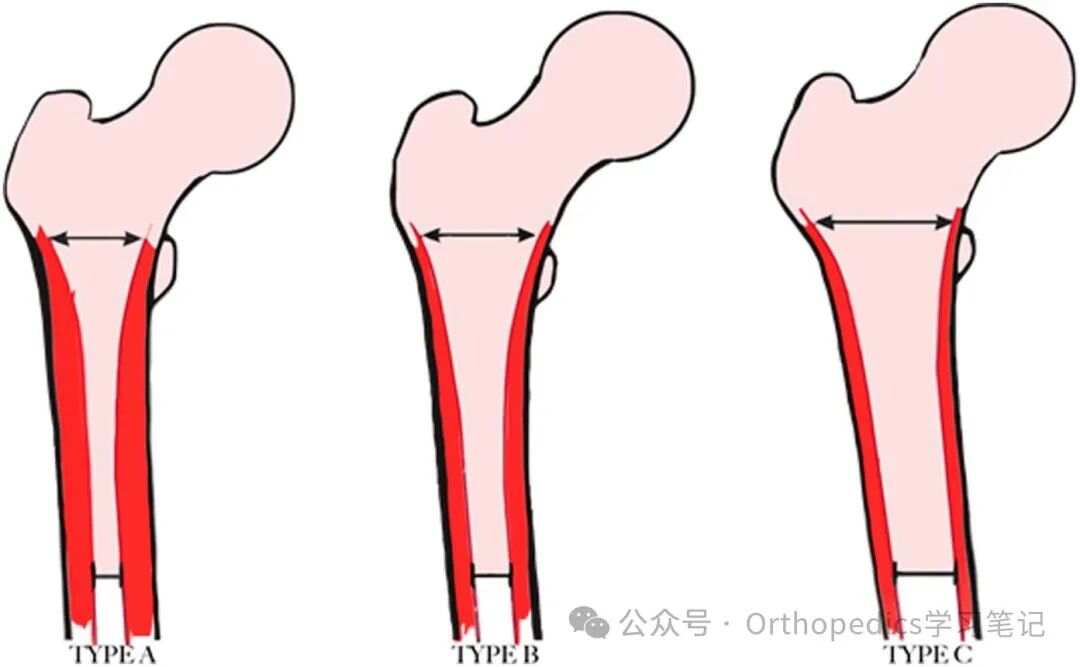 Dorr分型：股骨近端形态分型 - 上海开为医药科技有限公司--创伤、肢体矫形技术解决方案的专业服务商