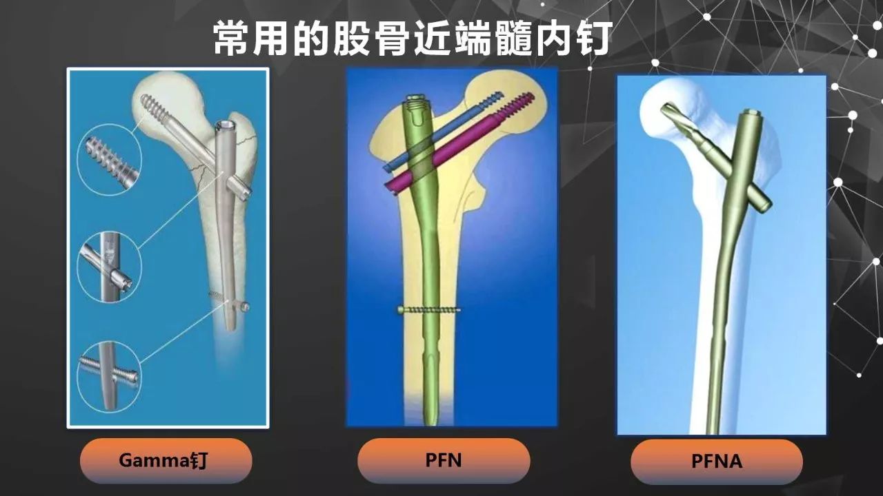 早读 | Intertan在股骨粗隆间骨折的应用及技术要点 - 上海开为医药科技有限公司--创伤、肢体矫形技术解决方案的专业服务商