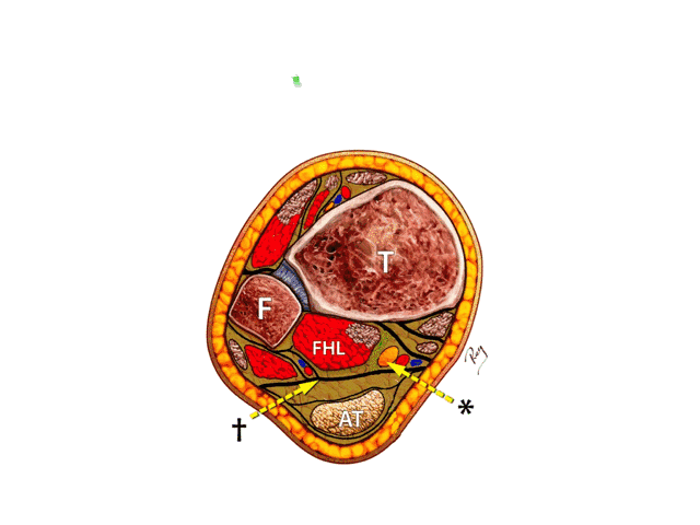 「病例分享」——复杂Pilon骨折病例讨论 - 上海开为医药科技有限公司--创伤、肢体矫形技术解决方案的专业服务商