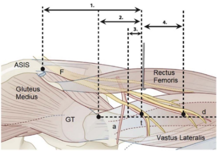 DAA入路髋关节翻修术：显露及截骨技术要点 - 上海开为医药科技有限公司--创伤、肢体矫形技术解决方案的专业服务商