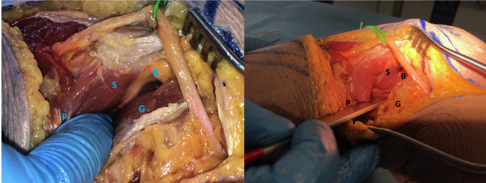 早读 | 一篇关于改良Frosch入路治疗后外侧胫骨平台骨折的技术说明 - 上海开为医药科技有限公司--创伤、肢体矫形技术解决方案的专业服务商