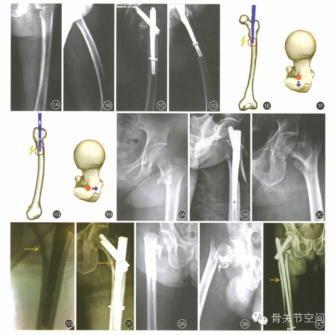 InterTAN髓内钉治疗股骨转子间骨折术中主钉置入困难怎么办？ - 上海开为医药科技有限公司--创伤、肢体矫形技术解决方案的专业服务商