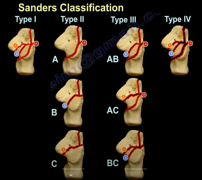 跟骨骨折的Sanders分型有何不足？有无更好的分型？ - 上海开为医药科技有限公司--创伤、肢体矫形技术解决方案的专业服务商