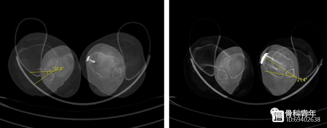 『8分钟创伤』胫骨远端MIPPO术后旋转畸形，功能有影响吗？ - 上海开为医药科技有限公司--创伤、肢体矫形技术解决方案的专业服务商