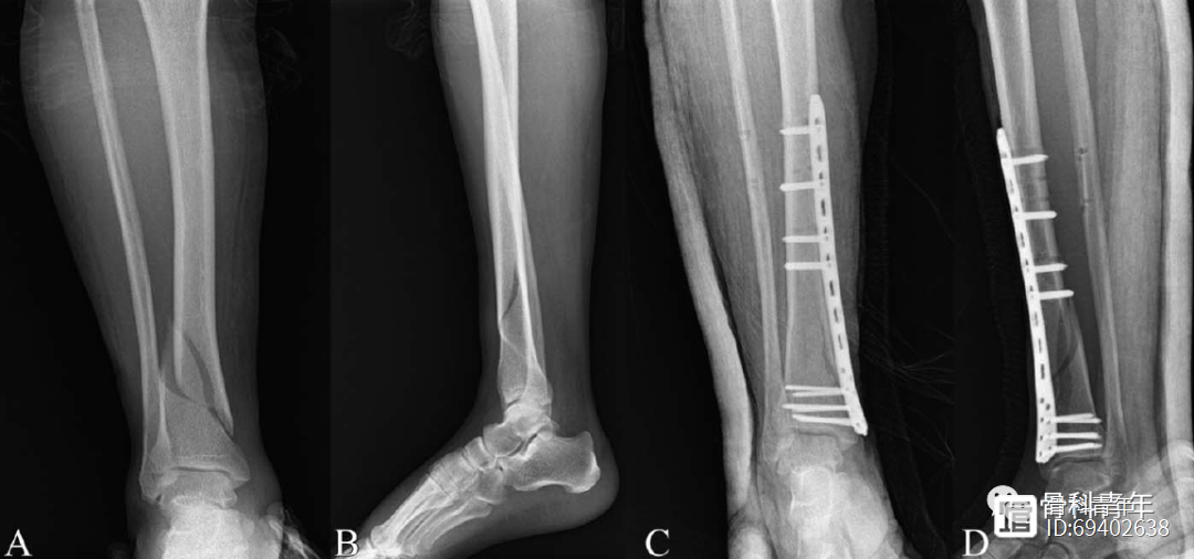『8分钟创伤』胫骨远端MIPPO术后旋转畸形，功能有影响吗？ - 上海开为医药科技有限公司--创伤、肢体矫形技术解决方案的专业服务商