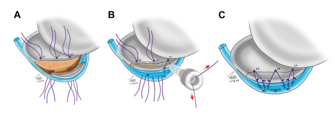 一文详解：关于骨性Bankart损伤的从诊断到治疗 - 上海开为医药科技有限公司--创伤、肢体矫形技术解决方案的专业服务商