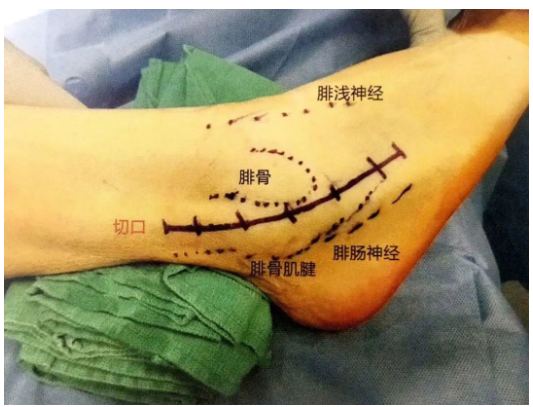 一文读懂：改良 Brostrom手术要点及操作技巧 - 上海开为医药科技有限公司--创伤、肢体矫形技术解决方案的专业服务商