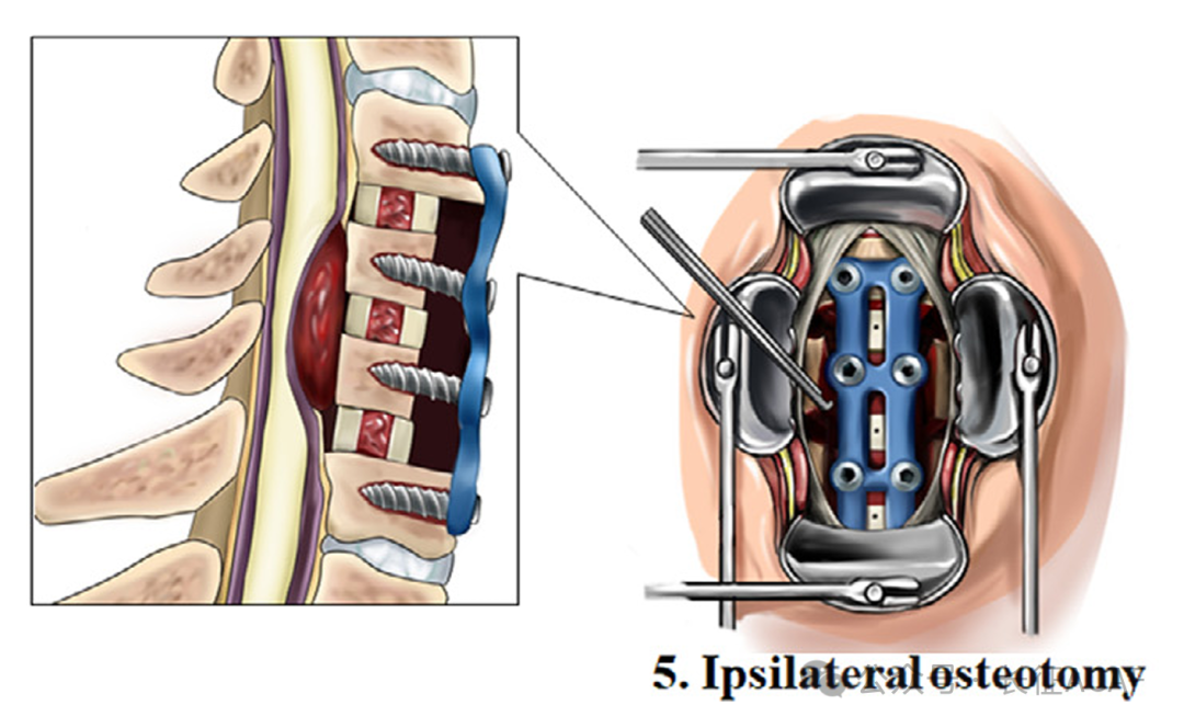 颈椎 ACAF 技术专题（**期）：ACAF 技术步骤示意图 - 上海开为医药科技有限公司--创伤、肢体矫形技术解决方案的专业服务商