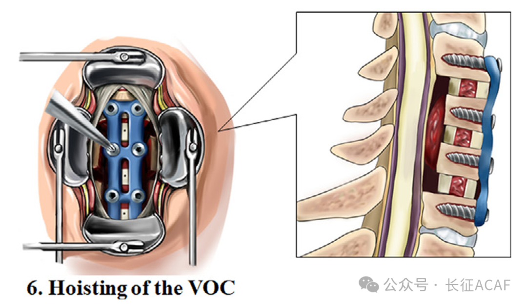颈椎 ACAF 技术专题（**期）：ACAF 技术步骤示意图 - 上海开为医药科技有限公司--创伤、肢体矫形技术解决方案的专业服务商