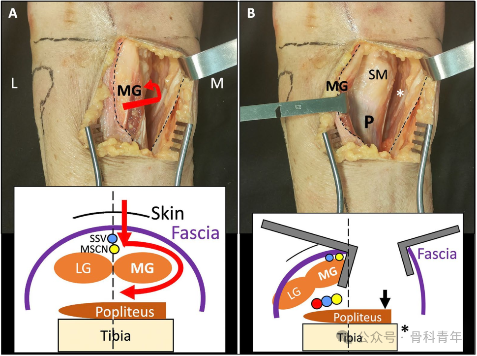 “改良斜行Lobenhoffer入路”显露胫骨平台后内侧 后外侧柱 - 上海开为医药科技有限公司--创伤、肢体矫形技术解决方案的专业服务商