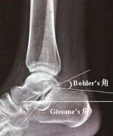 早读 | 跟骨骨折一文全搞定，干货满满！ - 上海开为医药科技有限公司--创伤、肢体矫形技术解决方案的专业服务商