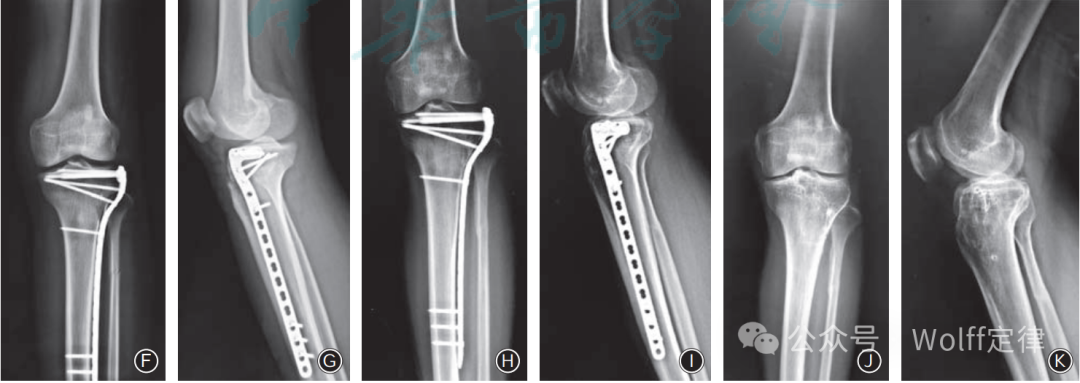 “反Schatzker IV型”胫骨平台骨折 - 上海开为医药科技有限公司--创伤、肢体矫形技术解决方案的专业服务商