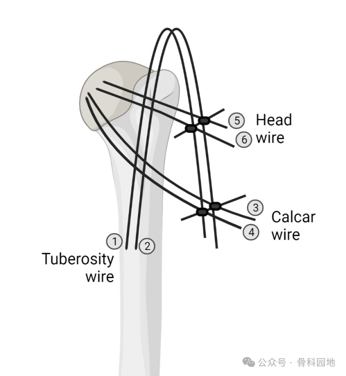 A Six-Pin Technique with the Joshi External Stabilization System for ...