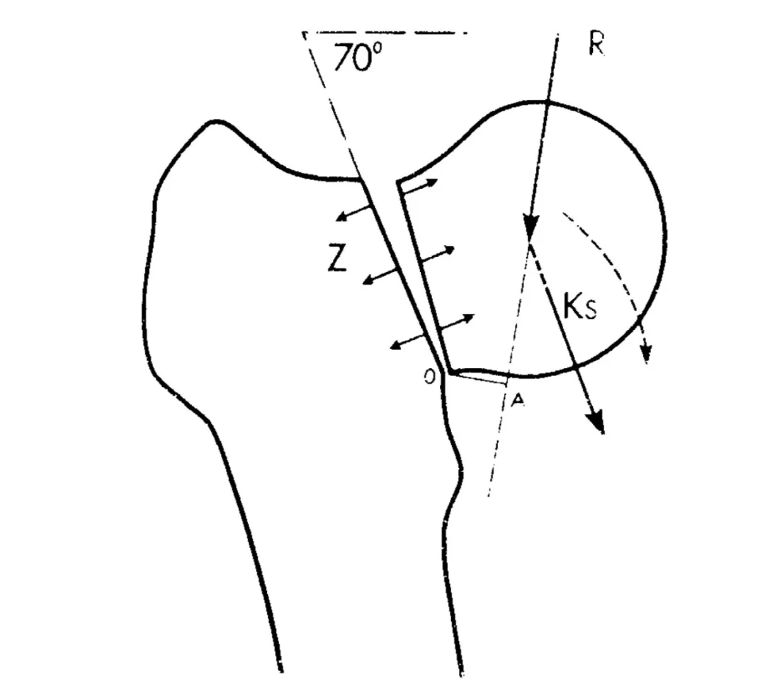 股骨颈骨折Pauwels分型：对原文的正确解释 - 上海开为医药科技有限公司--创伤、肢体矫形技术解决方案的专业服务商